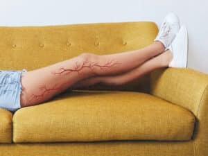 7 Foods to Help Varicose Veins and 5 Foods to Avoid – Wellness Gaze